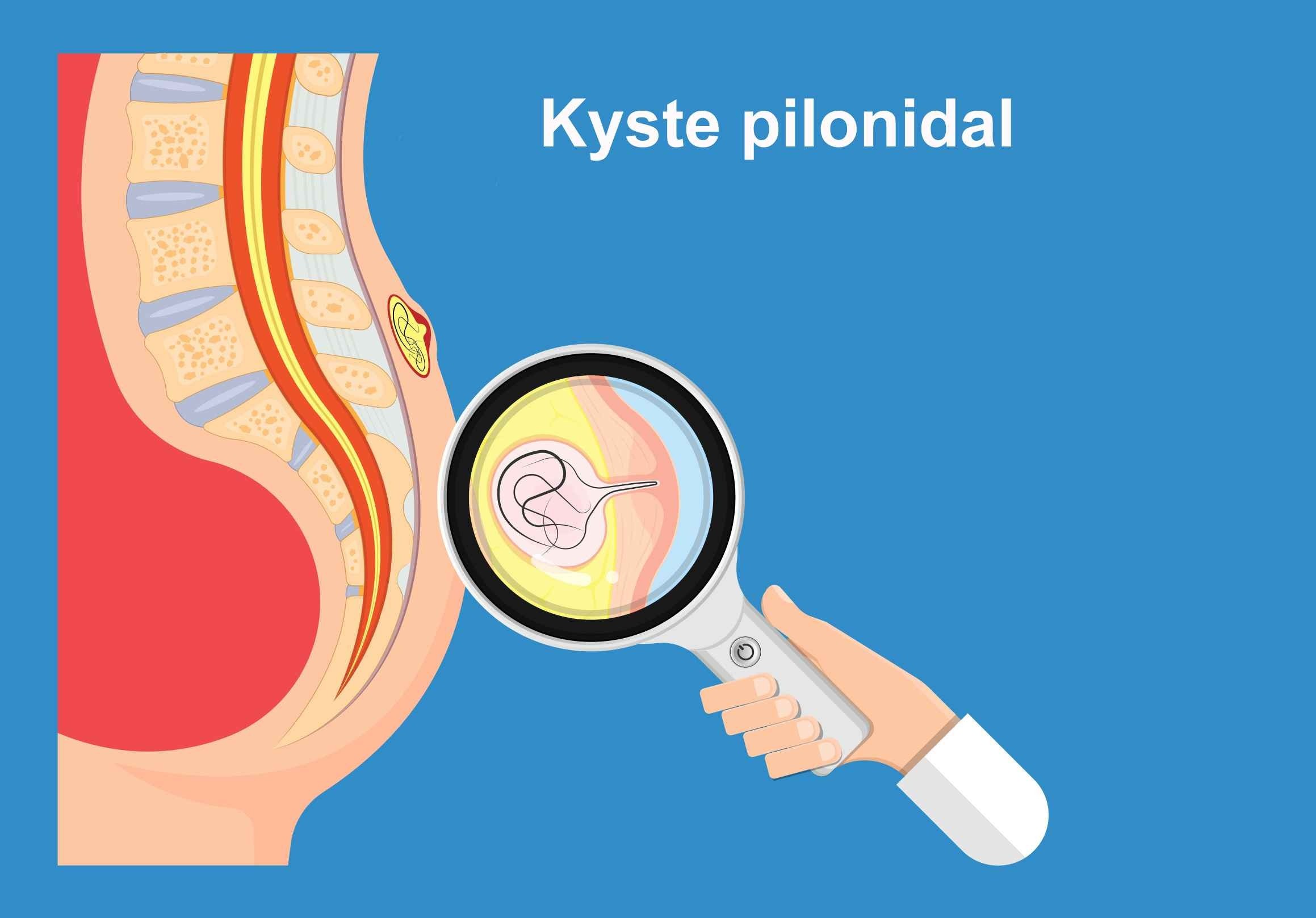 Kyste pilonidal (ou sacro-coccygien) : symptômes et traitements