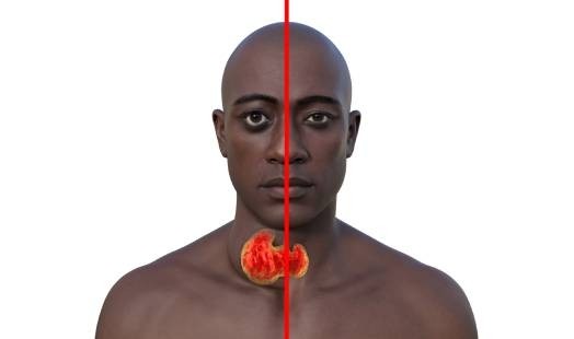 Maladie de Basedow : symptômes, causes et traitements