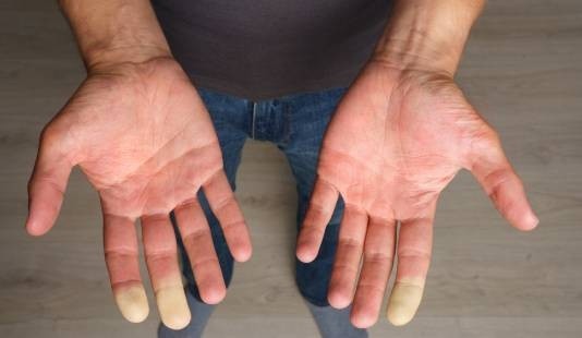 Syndrome de Raynaud : les causes et les traitements - Conseil Pharmacien